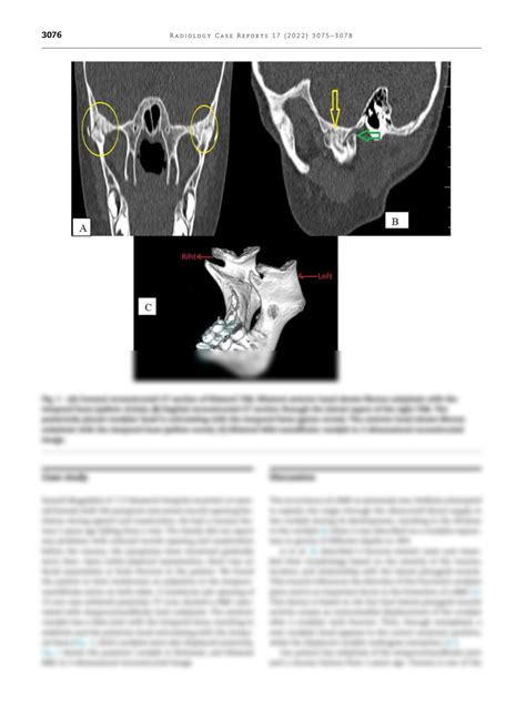 Solution Bilateral Bifid Mandibular Condyle Associated With Ankylosis Of The Temporomandibular