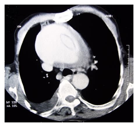 Ct Scan Of The Chest With An Intimal Flap Separating The True And False