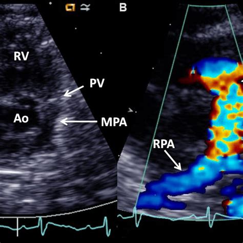Selected Video Frame From Suprasternal Notch Views Of The Aortic Ao Download Scientific