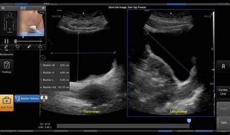 GE Ultrasound Feature Bladder Volume Tool Efficient Bladder Volume Measurements