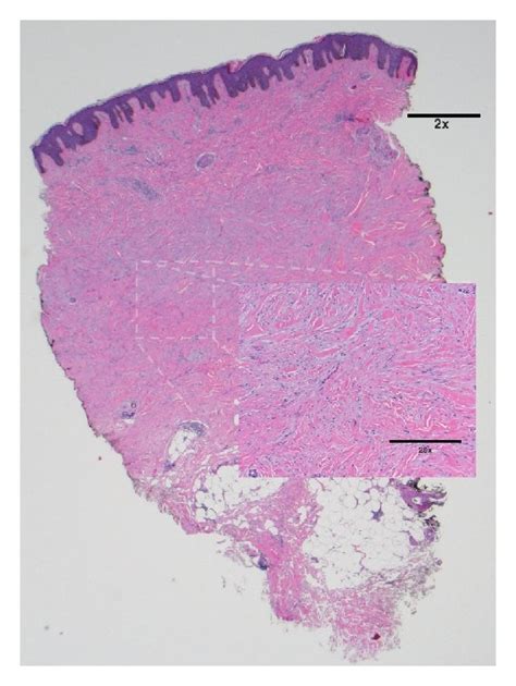 Keloidal Scleroderma Histologic Sections Show An Acanthotic Epidermis