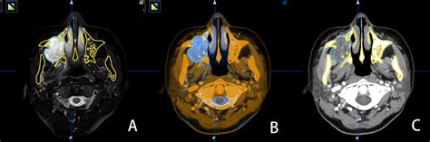 Mri Image With Tumor Boundary Depicted In Blue A The Software Download Scientific Diagram