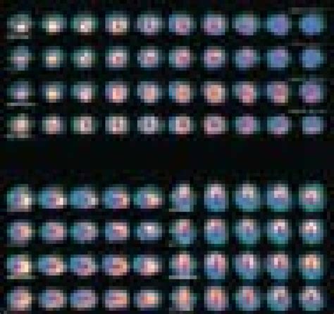 Advantage Of Spect Ct Attenuation Corrected Cardiac Imaging Download Scientific Diagram