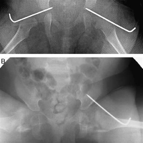 Arthrogram Of Bilateral Developmental Dysplasia Of The Hip Showing Download Scientific Diagram