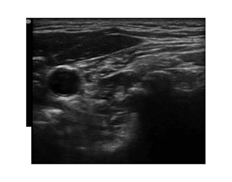 Intermediate Cervical Plexus Block Quiz