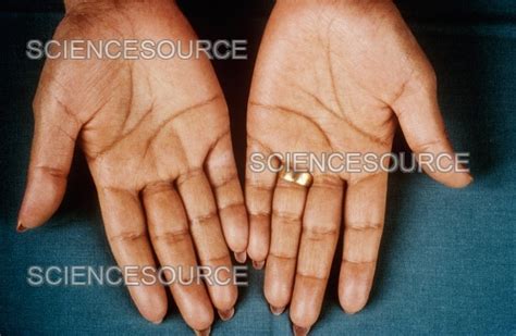 Hemosiderosis Stock Image Science Source Images