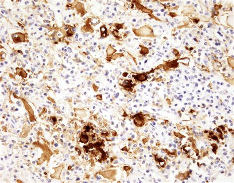 Pathology Outlines Myxoinflammatory Fibroblastic Sarcoma