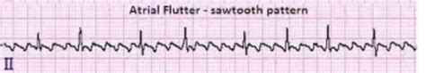 Sfp Supraventricular Tachycardia Flashcards Quizlet