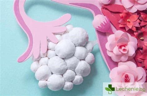 ᐉ Синдром на поликистозните яйчници какво е — Lechenie Bg