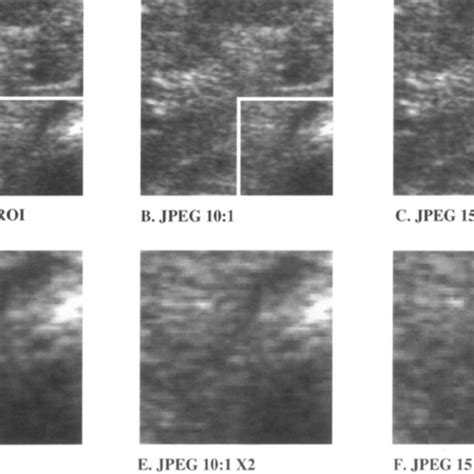 Pdf Ultrasound Grayscale Image Compression With Jpeg And Wavelet Techniques