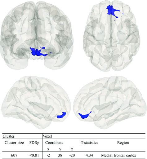 Cortical Areas Showing Decreased Connectivity With The Bilateral