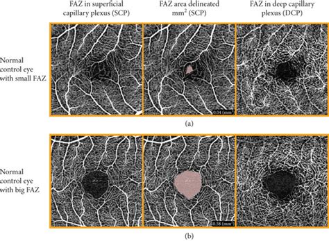 Octa Scans From Two Control Eyes This Illustrates How The Faz Area Is