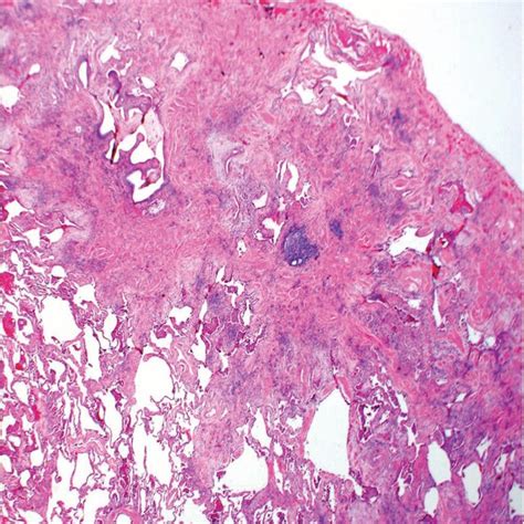 Fibroblastic Foci With Dense Collagen Fibrosis Download Scientific