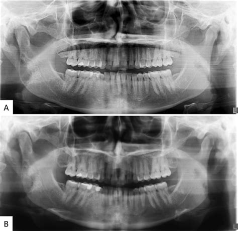 Peripheral Ossifying Fibroma Radiograph