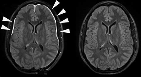 Meningitis Concise Medical Knowledge