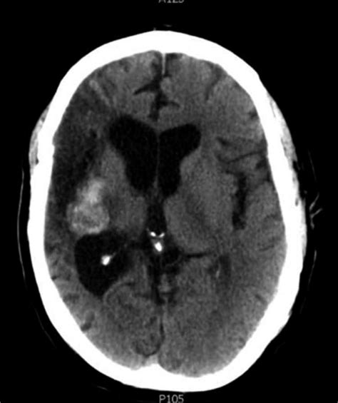 Axial Ct Head 2007 Demonstrating Hyper Dense Cystic Abnormality In