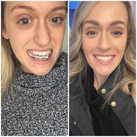 Best R Braces Images On Pholder Its Been One Month Since Debrace