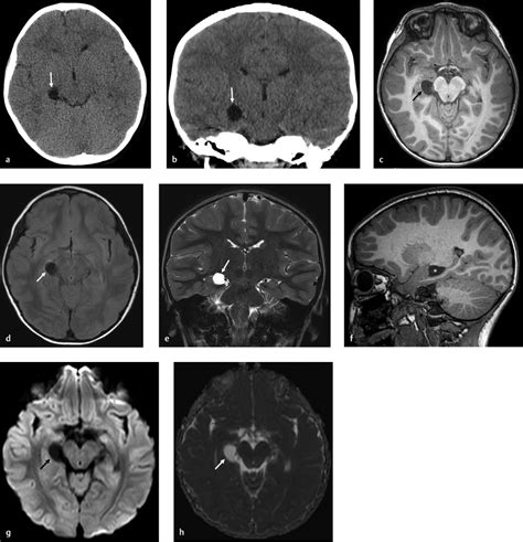6 Choroid Fissure Cyst Radiology Key