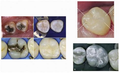 Restoration Of The Root Treated Tooth Flashcards Quizlet