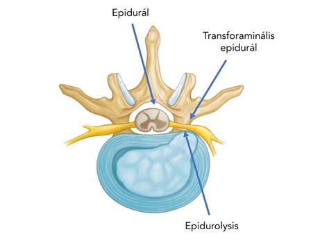 Transforaminal Epidural Block Fájdalomklinika