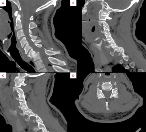 Ct Imaging A Sagittal View Of Bilateral Facet Dislocation With Bony Download Scientific