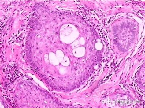 肺癌的病理分类 知乎