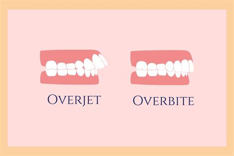 Whats The Difference Between An Overbite And An Overjet Corrective