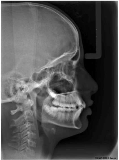 Pre Treatment Lateral Cephalogram Download Scientific Diagram