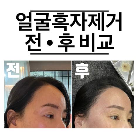 안산 중앙역 피부과 리팟레이저 흑자제거후기 가격 공유 네이버 블로그