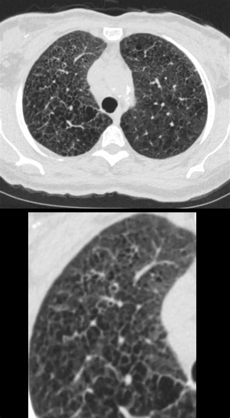 Faces Of Centrilobular Nodules Size Lungs