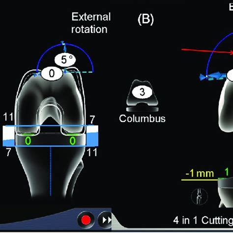 Adjustment Of Femoral Component Rotational Alignment A To Obtain A