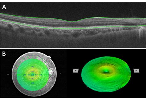 Determining Gender Based Differences In Retinal And Choroidal Thickness In Underweight