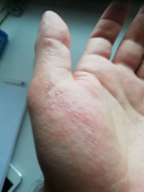 Высыпания на ладонях и пальцах Вопрос дерматологу 03 Онлайн