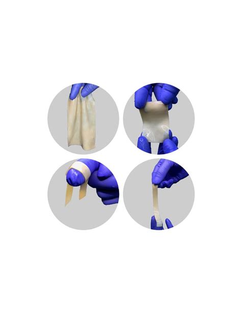 The Utility Of Invengenx® Bovine Patch For Right Ventricular Outflow Tract Rvot Reconstruction