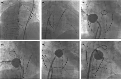 A And B X‐ray Fluoroscopic Images In Right Anterior Oblique The X‐ray Download Scientific