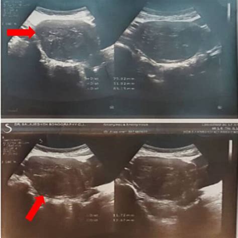 Abdominopelvic Ct Scan Showing Markedly Thickened And Edematous Download Scientific Diagram