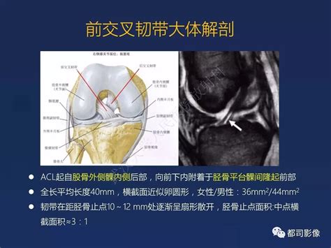 前交叉韧带损伤及重建术后的MR评价 好医术早读文章 好医术 赋能医生守护生命