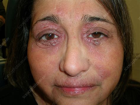 Atopic Dermatitis Stock Image C0565334 Science Photo Library