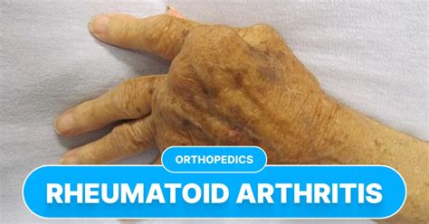 Rheumatoid Arthritis Symptoms Causes And Treatments