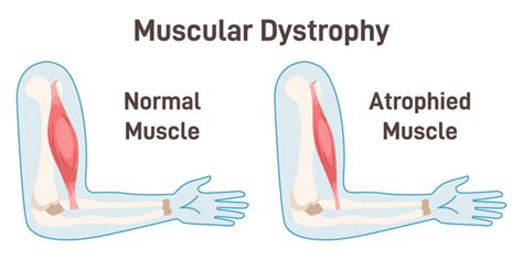 รปภาพContraction เลอกดภาพถายสตอก เวกเตอร และวดโอ35 292 Adobe Stock