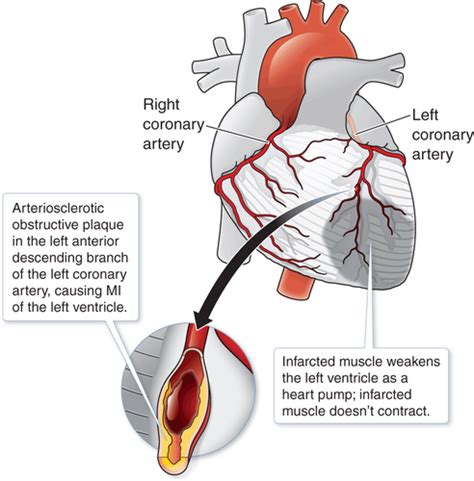 Pathophysiology Chapter 17 Heart Failure Flashcards Quizlet