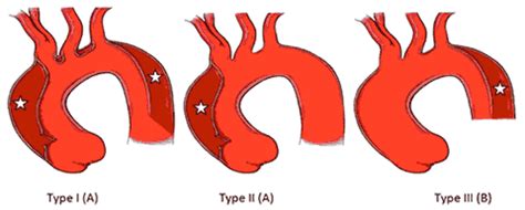 Acute Aortic Dissection