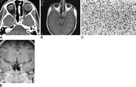 A Contrast Enhanced Ct Scan Shows A Soft Tissue Mass Arrows In The