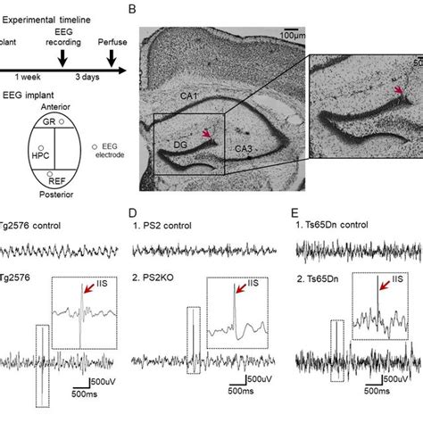 Iis Is A Robust Eeg Abnormality In Three Mouse Models Of Ad A A1