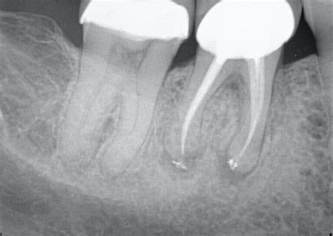 Vertical Root Fracture Symptoms Causes And Treatment