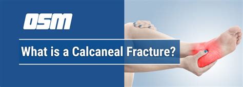 What Is A Calcaneal Fracture Orthopedic And Sports Medicine