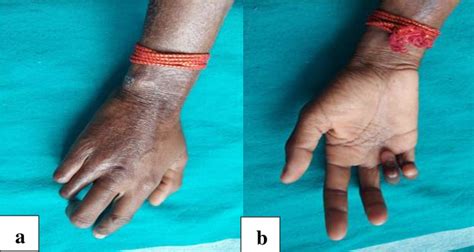 A And B Linear Morphea Affecting The Right Side Trunk And Upper Limb Download Scientific