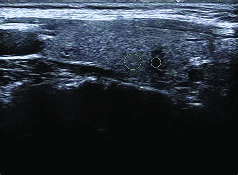 Female Patient 45 Years Old 1 Week Case History Of A Thyroid Nodule Download Scientific