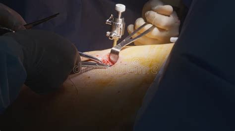 Professional Surgeons Stitch Wound After Laparoscopic Surgery Stock