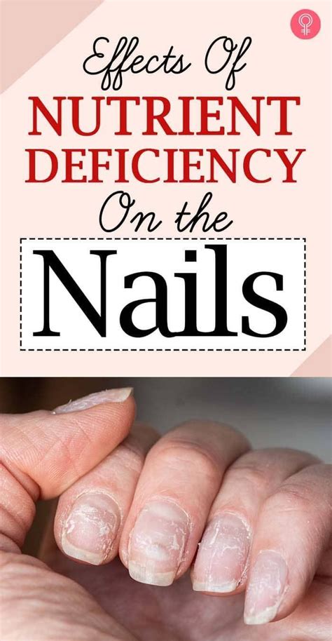 Zinc Deficiency Symptoms Nutrient Deficiency Vitamin Deficiency Nail Vitamins Gummy Vitamins